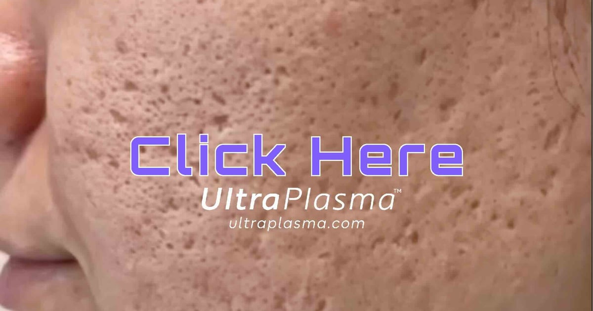 UltraPlasma™ Acne Scars Treatment | UltraPlasma™ Human Reconstruction ...