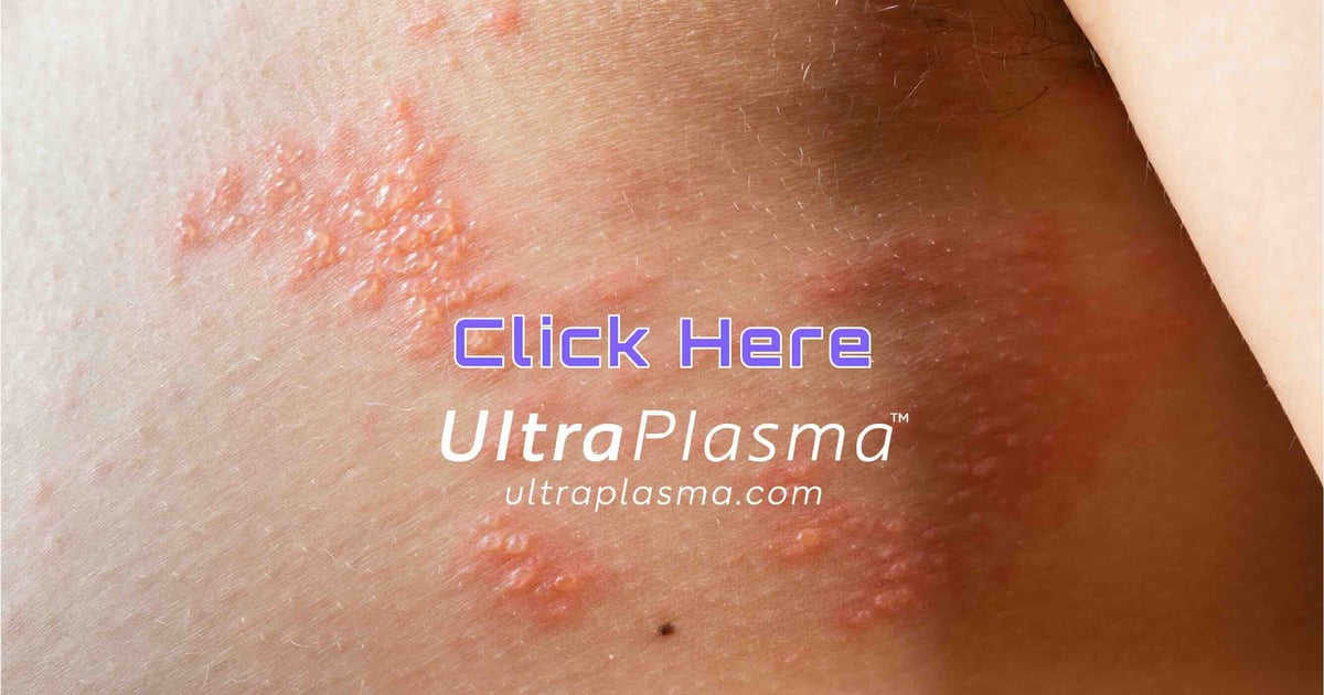 UltraPlasma™ Chicken Pox Rash Treatment | UltraPlasma™ Human ...