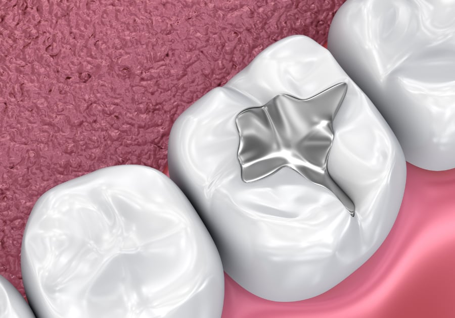 Types of Dental Fillings | Northmead Health Centre