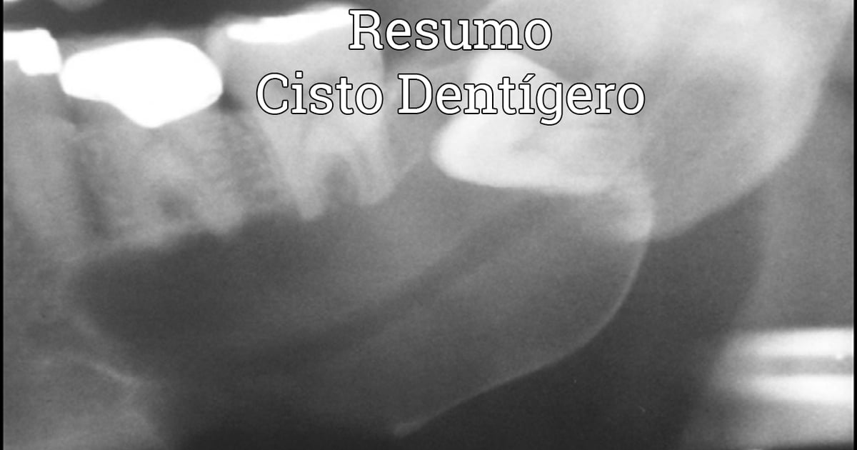 Cisto Dentígero Resumão - Características e Tratamento | Odontologia ...