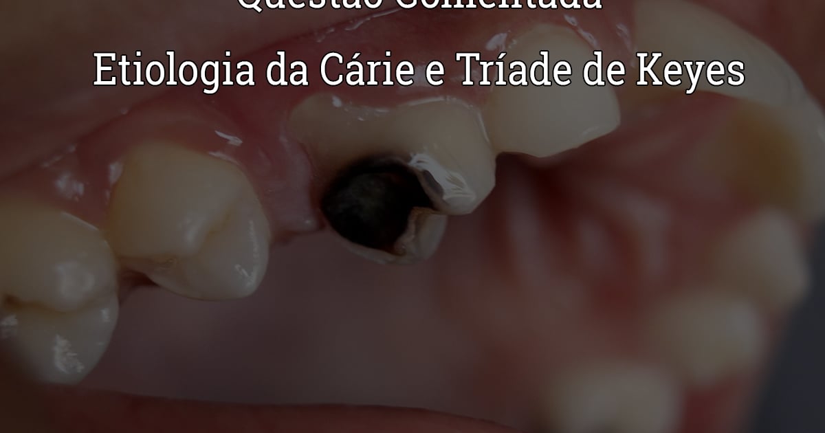 Etiologia da Cárie e Tríade de Keyes | Odontologia com André