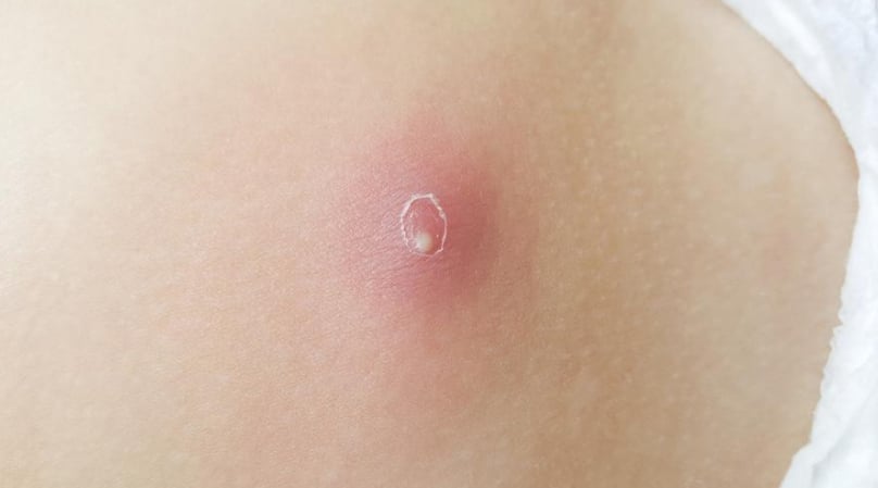 Furúnculo: Causas, Sintomas e Tratamentos para Infecção Cutânea | SPASS