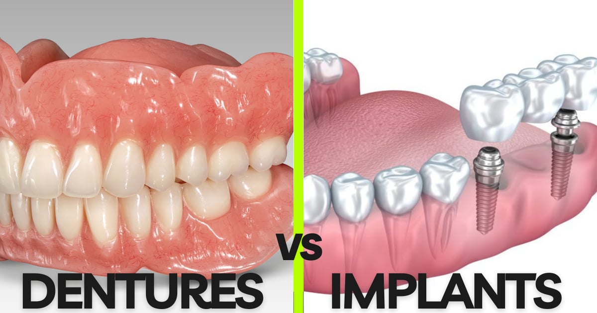 Dental Implants vs Dentures: Choosing the Best Tooth Replacement Option ...