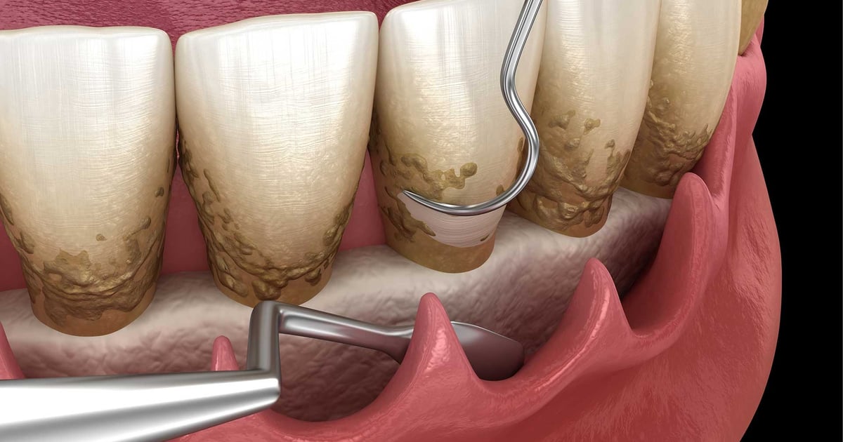 Comprehensive Dental Cleaning to Remove Plaque | Scaling and Root ...