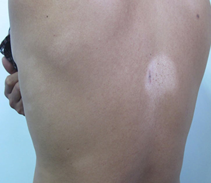 Restoring Skin Color: Unveiling Hypopigmentation Causes and Treatment ...