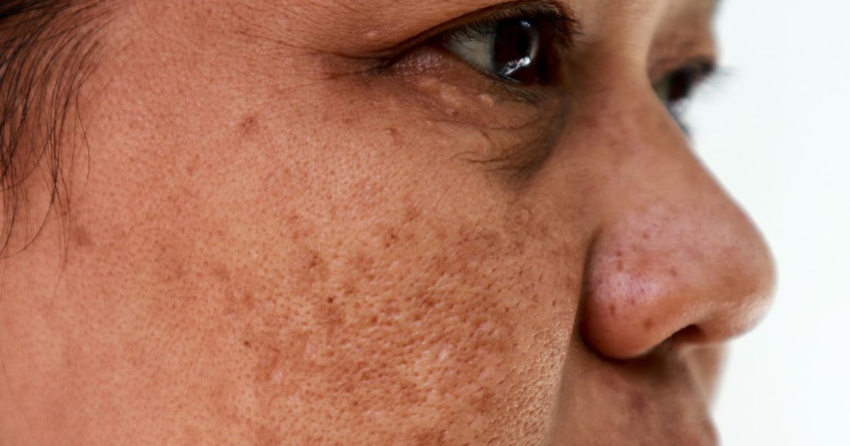 Treating Hyperpigmentation | Melasma, Dark Spots & Age Spots | White ...