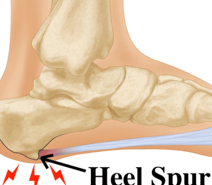 Heel Spur Pain Relief: Natural Homeopathic Treatments in Hubli, Dharwad ...