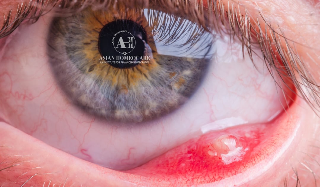 Homeopathic Remedies for Styes Effective Treatments Asian Homeocare Homeoapthy clinics and Doctors