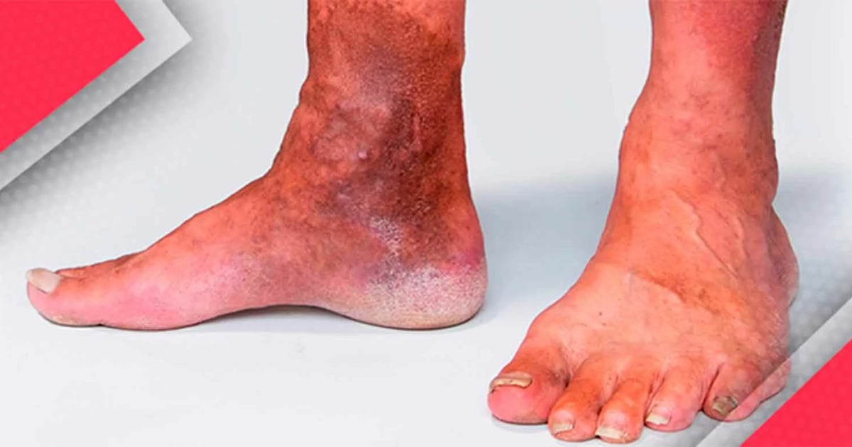 Todo lo que Necesitas Saber sobre las Úlceras Venosas: Causas ...