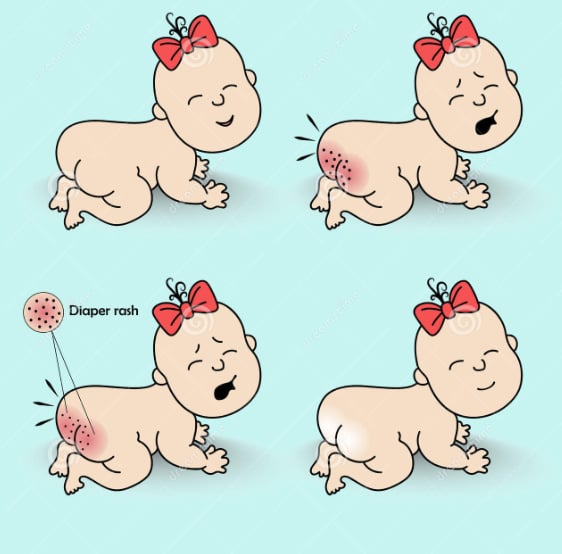 Les fesses rouges chez le nourrisson : causes, prévention et soins ...