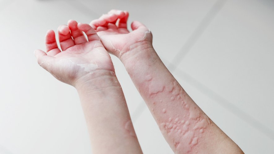 Les allergies chez l’enfant : causes, symptômes et solutions | Centre ...