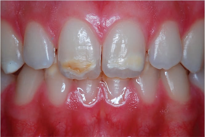 Managing Orthodontic Treatment in Patients with Enamel Hypoplasia ...