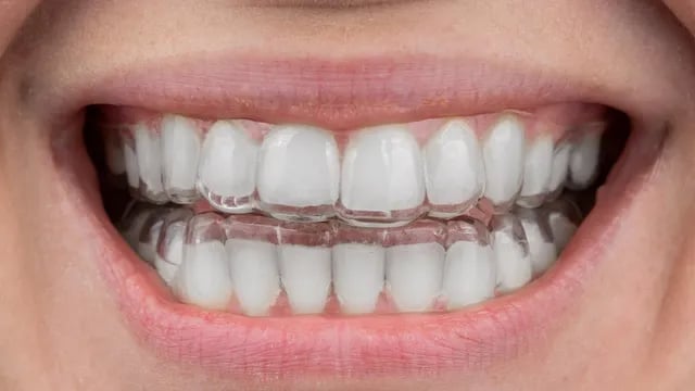 Clear Aligners for Patients with Sialorrhea: Managing Excessive ...