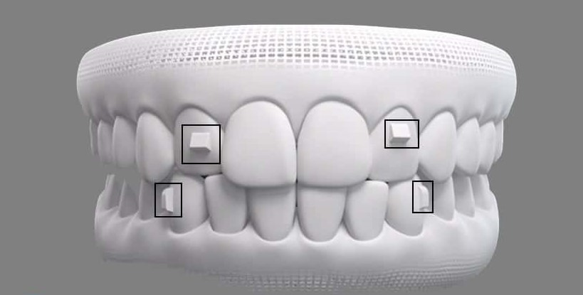 The Role of Attachments and Buttons in Aligner Treatment | ClearCare Ortho