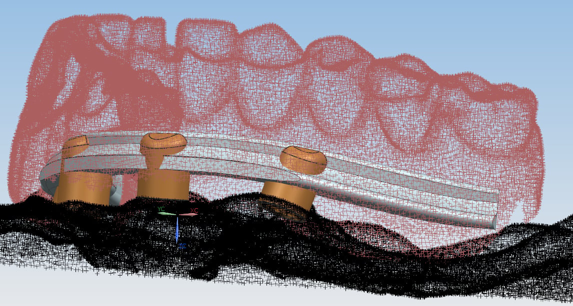 Distal Extensions, Preventing Potential Failures | Memphis Dental ...