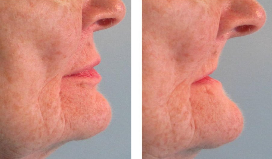 The Importance of Lip Support | Memphis Dental Implant Surgery Center