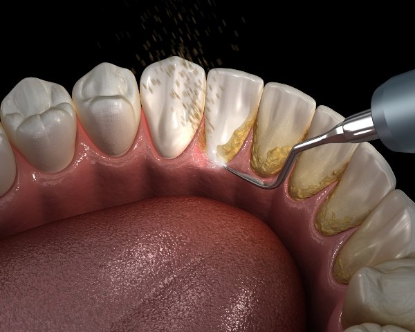 ¿Qué es el sarro dental? | Clinica Dental Sun