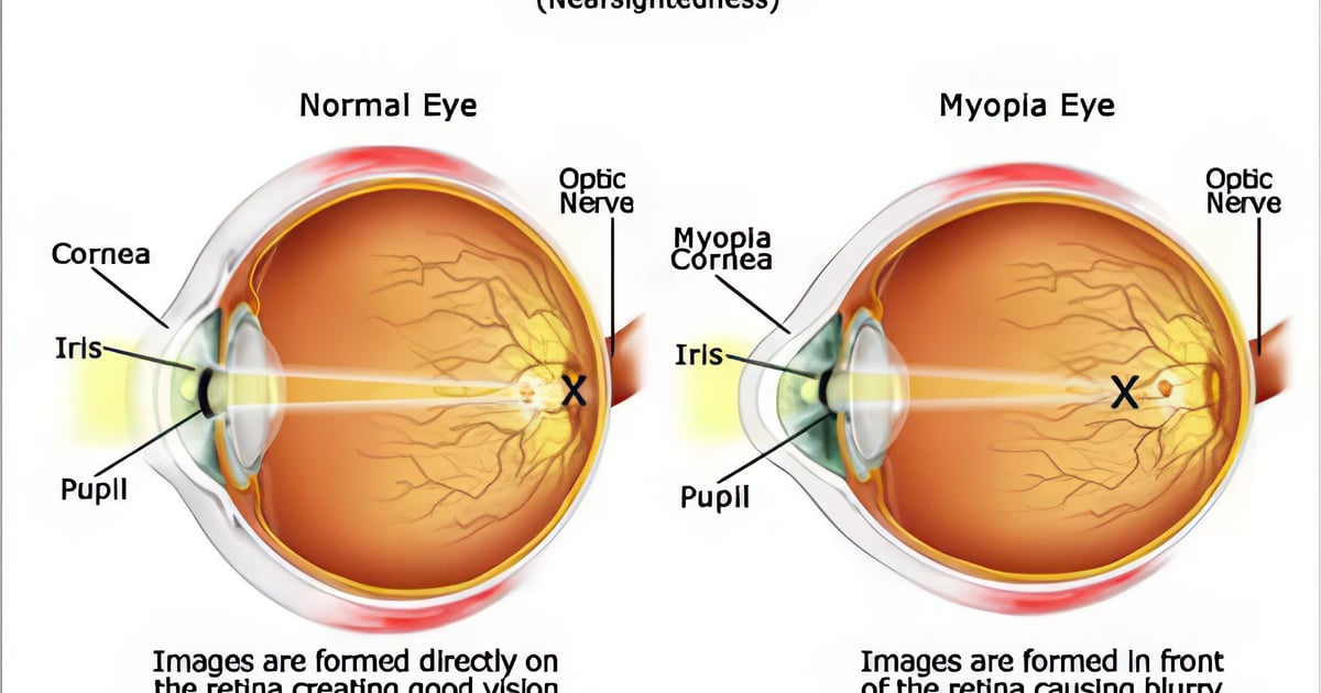 Myopia | Humber Eye Center