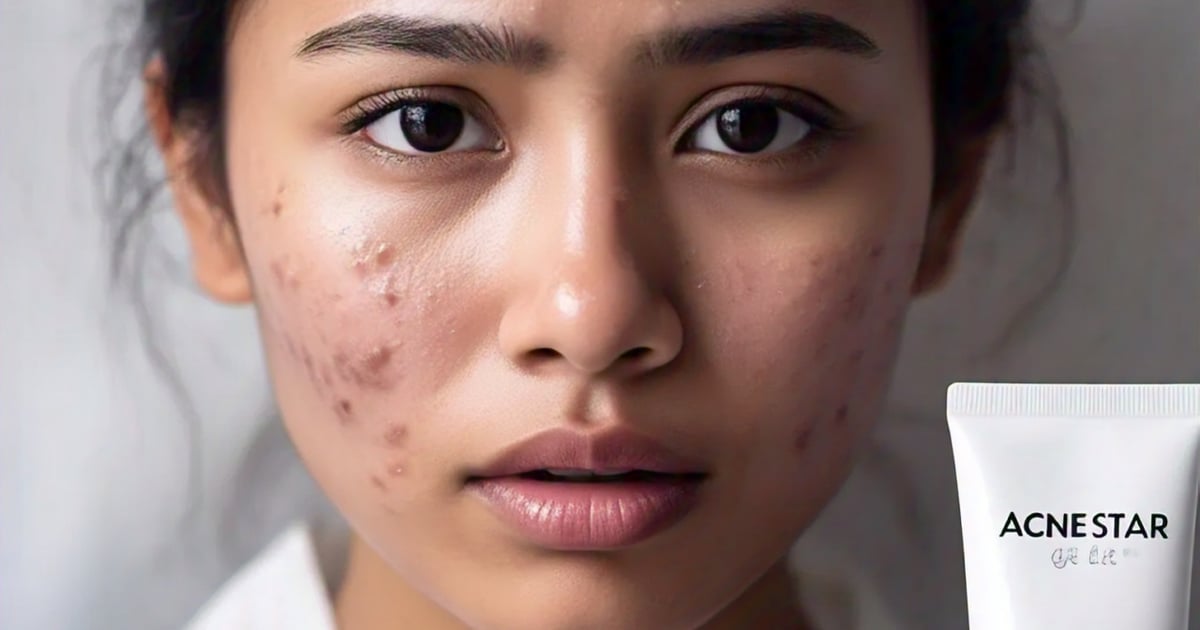 Acne Star: Uses and side effects | Medinsight Hub