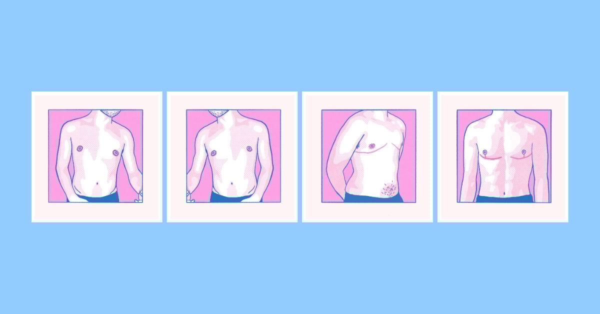 The Types of Top Surgery in the Philippines
