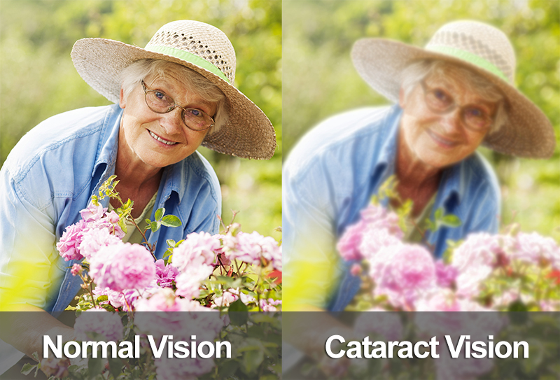 Cataracts and How It Affects Your Vision | Deja Vu Optics