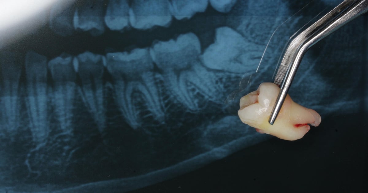 Gigi Impaksi: Kenali Penyebab, Gejala, dan Solusinya – Panduan oleh ...