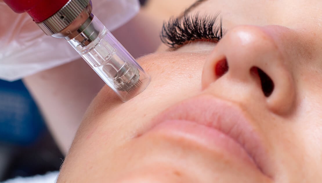What is ‘Vampire Facial’? Potential risks. | Panamedico