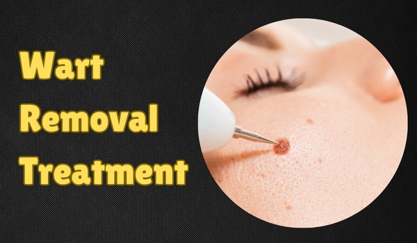 Wart Removal Treatment at Dermacore Clinic | Dermacore