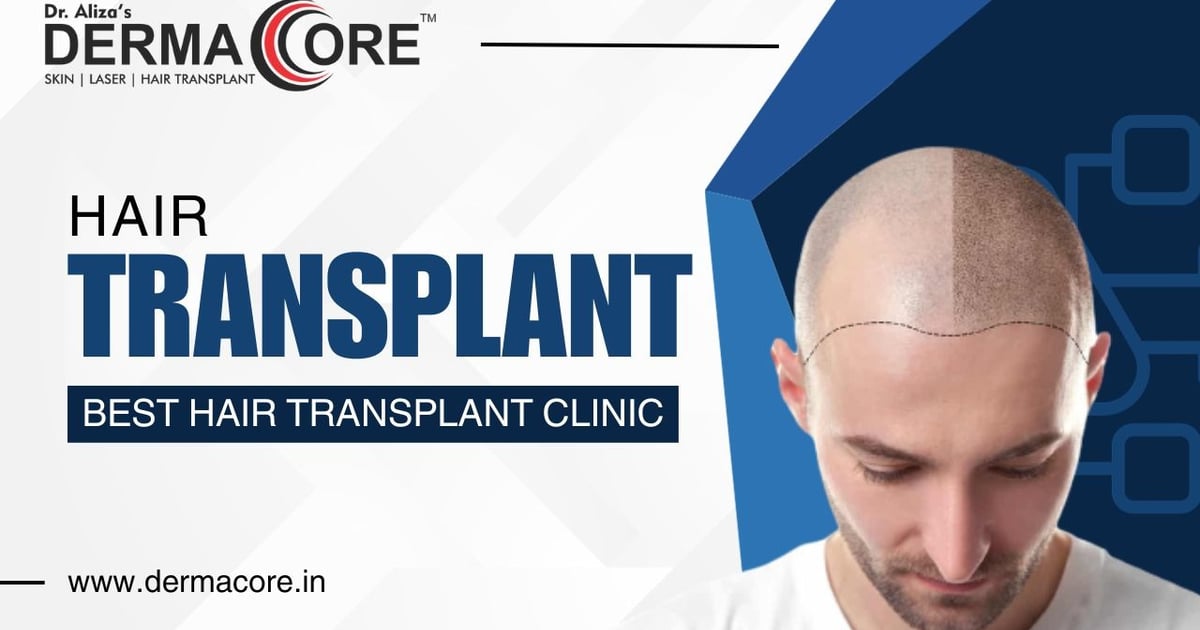 What is Hair Transplant? Understanding the Procedure and Benefits ...