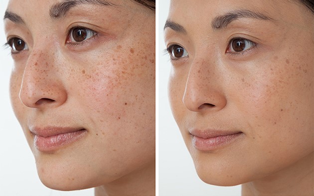 Kẻ thù của làn da: Cách kiểm soát nám | Calliane cosmetics, Calliane ...