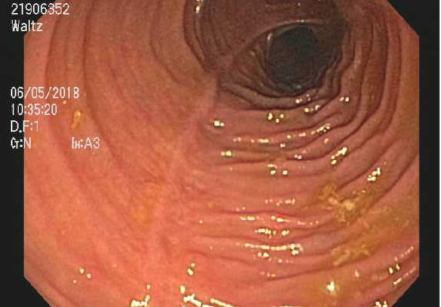 Pouchoscopy | Dr. James Church