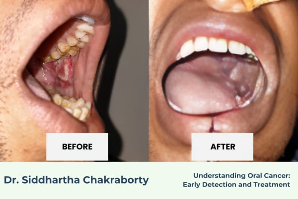 Understanding Oral Cancer: Early Detection and Treatment