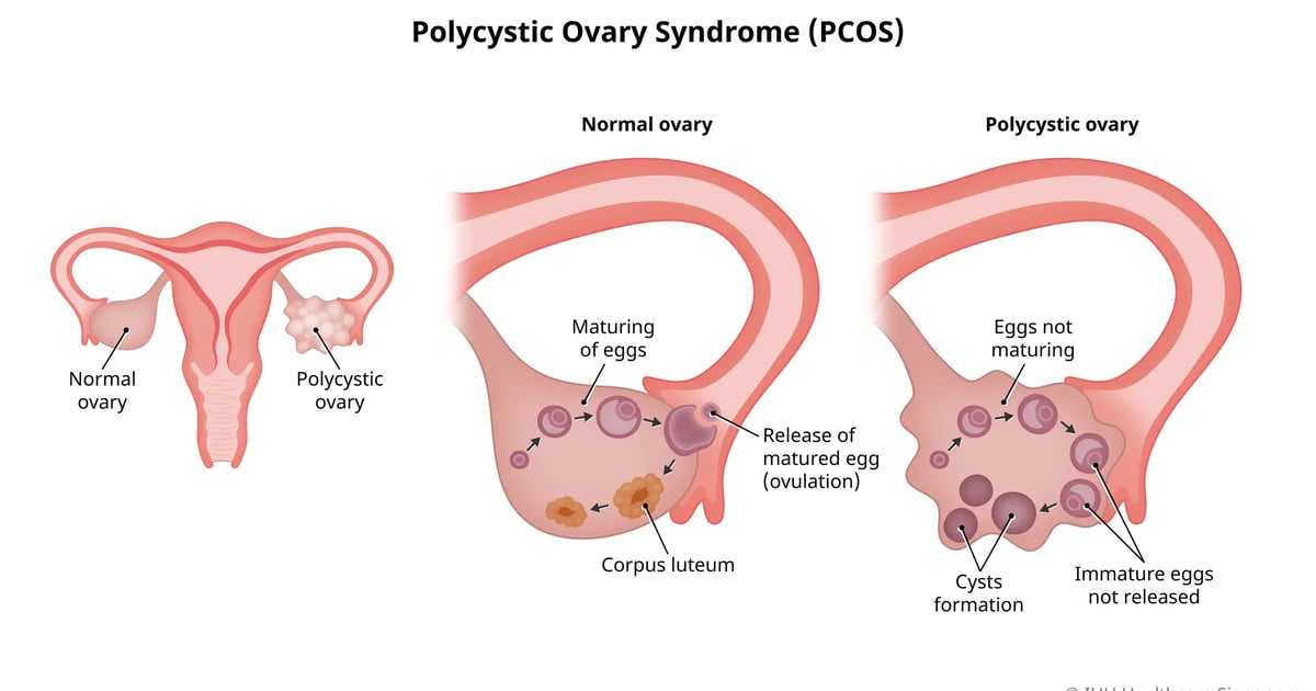 Managing Polycystic Ovary Syndrome (PCOS): Insights and Treatment ...