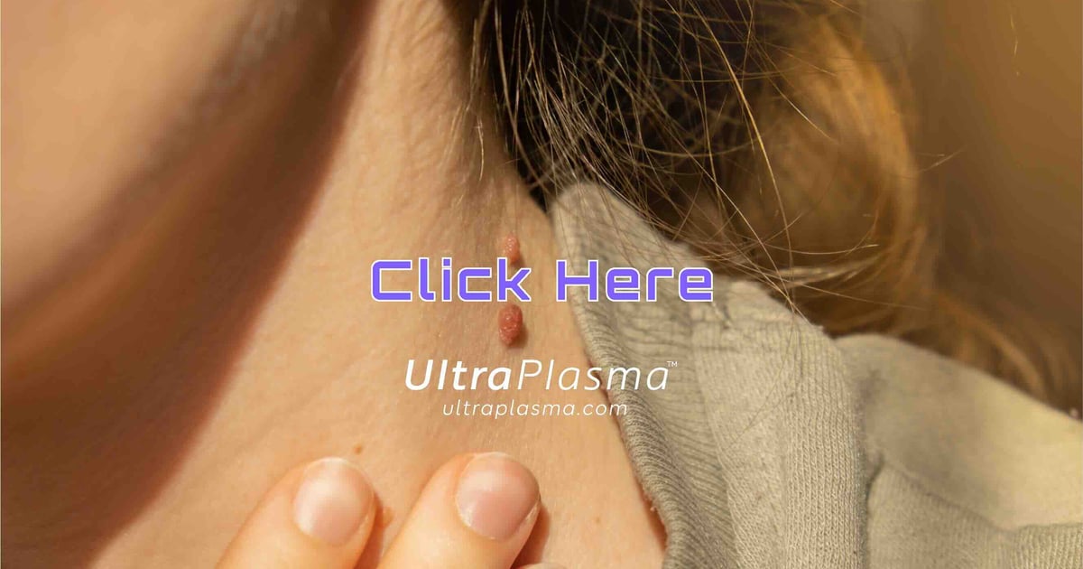 UltraPlasma™ Skin Tag Removal | UltraPlasma™ Human Reconstruction Devices