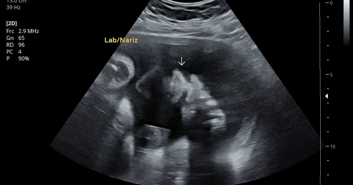 Ultrasonido obstétrico: diferencias entre 2D, 3D y 4D HD | Ultrasonido Itza