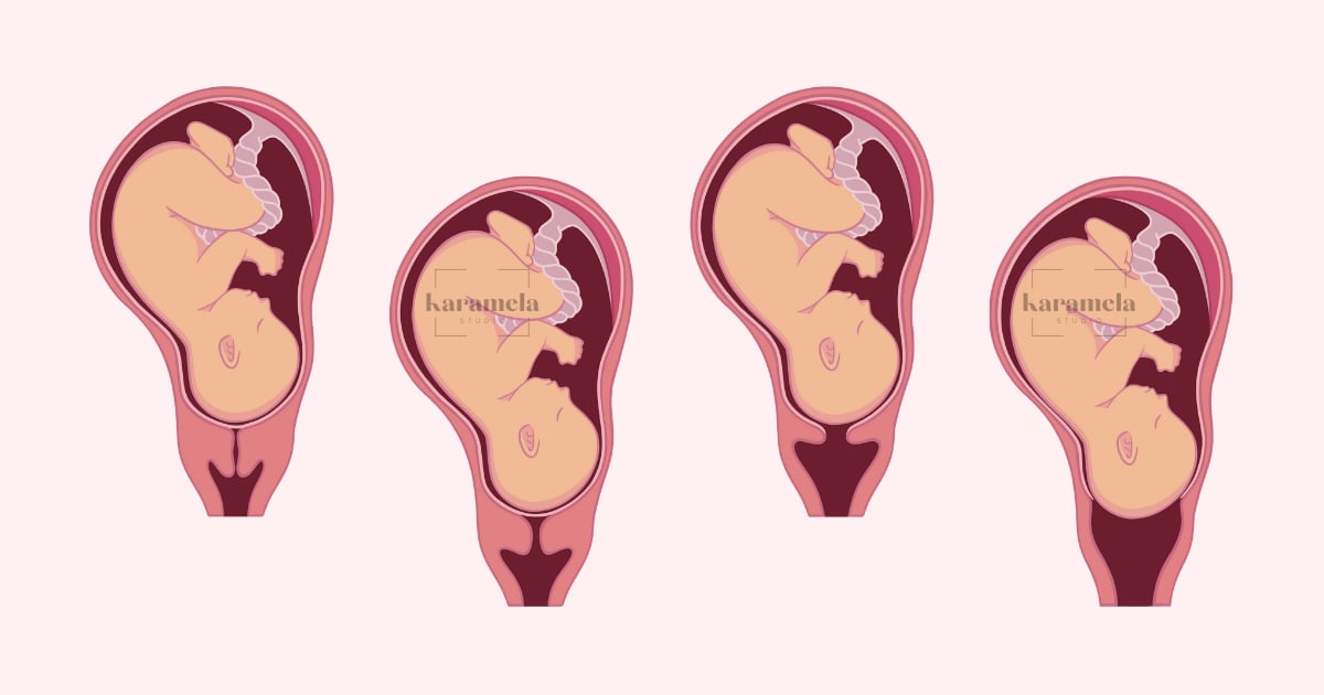 Cervical Dilation and Effacement Explained | Karamela Studio