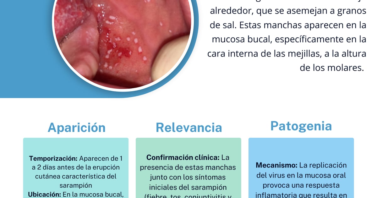Signo de Koplik: Indicador Temprano y Crucial del Sarampión | Resúmenes ...