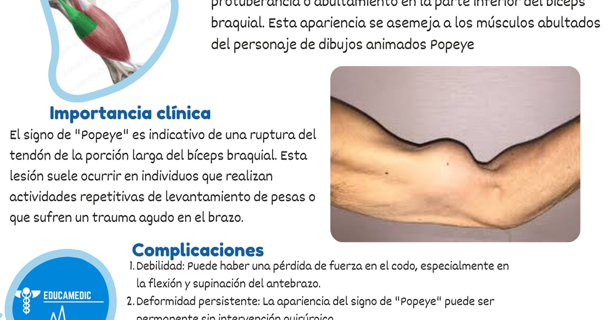 El Signo de 'Popeye': Diagnóstico y Tratamiento de la Ruptura del ...