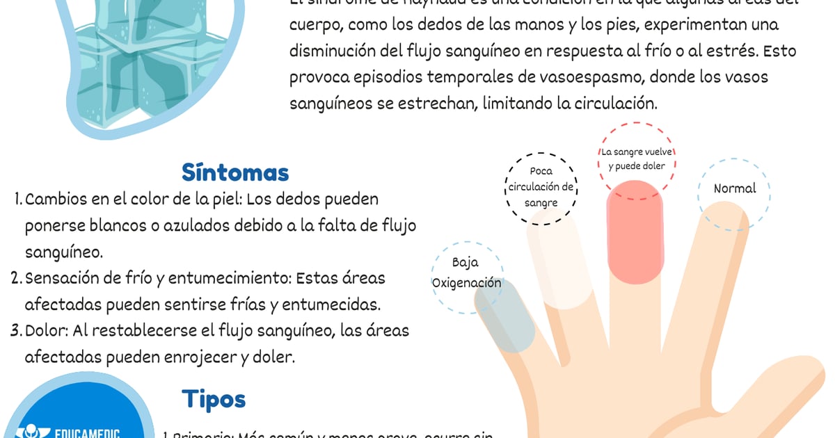 Síndrome de Raynaud: Síntomas, Tipos y Tratamientos Efectivos ...