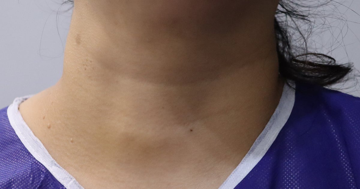 Cystic Nodule with Multinodular Goiter and Branchial Cleft Cyst | SST