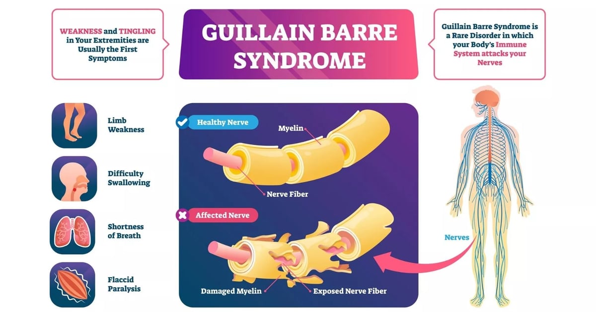 Understanding Guillain-Barré Syndrome (GBS) Symptoms in Simple Terms | Prism Biopharma