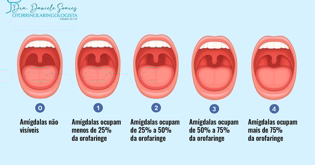 Classificação de Brodsky: quando as amígdalas aumentadas merecem ...