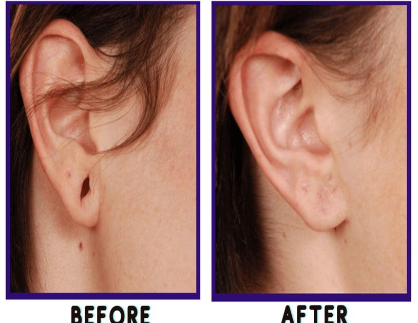 Ear lobe Repair | Best Dermatologist In Vadodara