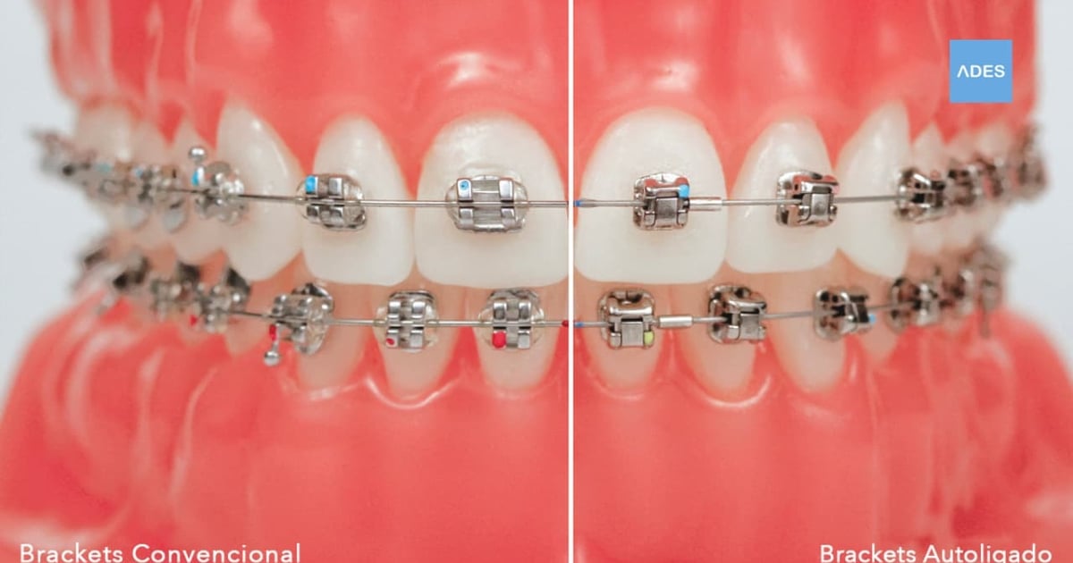 Brackets Autoligables vs. Brackets Convencionales: ¿Cuál es Mejor ...