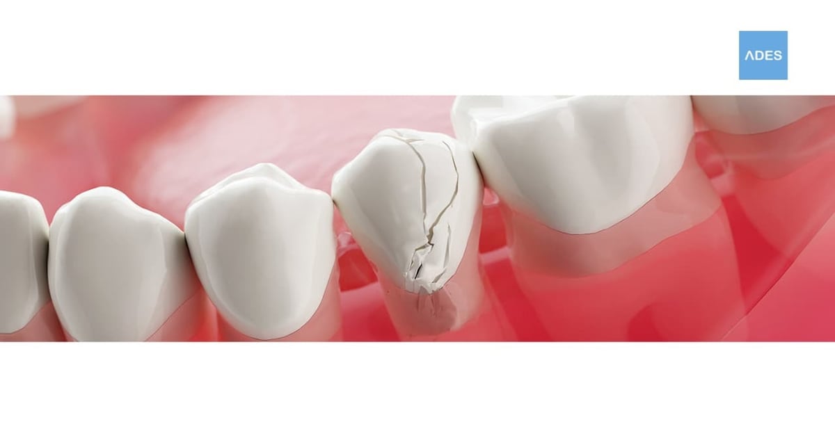 Dientes Astillados en Badajoz: Causas, Tratamientos y Cómo Recuperar tu ...