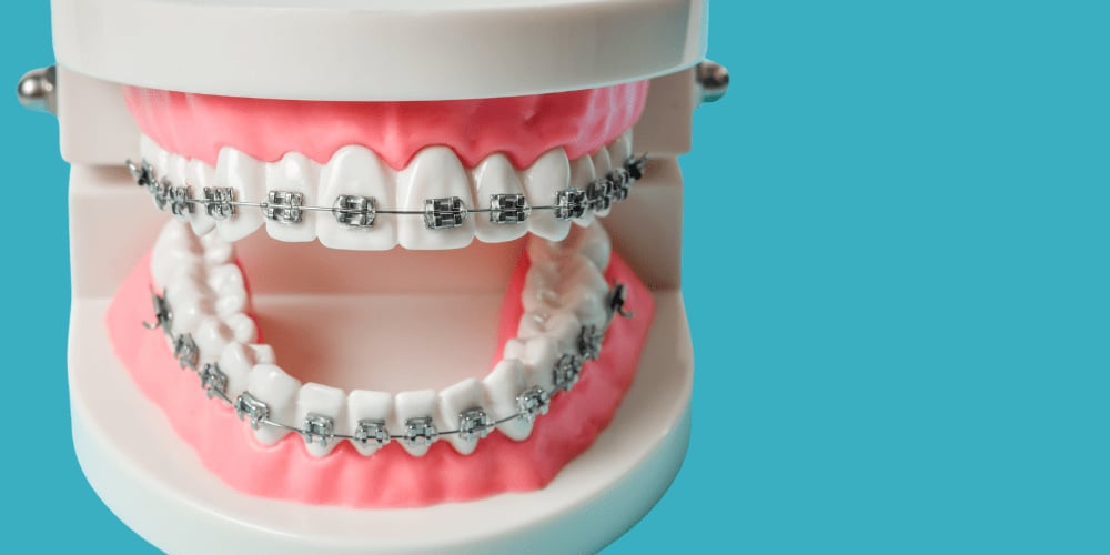 How Much Do Braces Cost In Australia? 2025 Price Guide