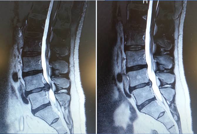 L4 L5 disc buldge treatment using Varmam and Chiropractic Adjustment ...
