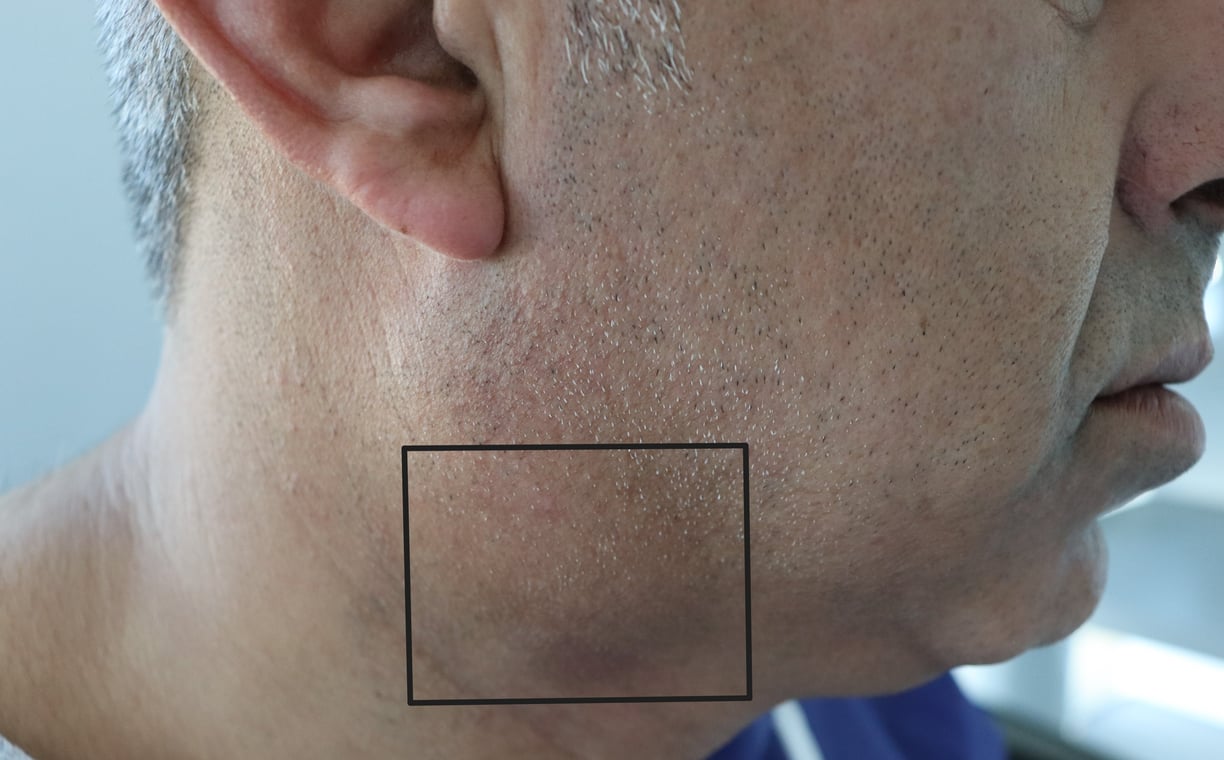 Management of a 40-Year-Old Male with an Infected Second Branchial ...