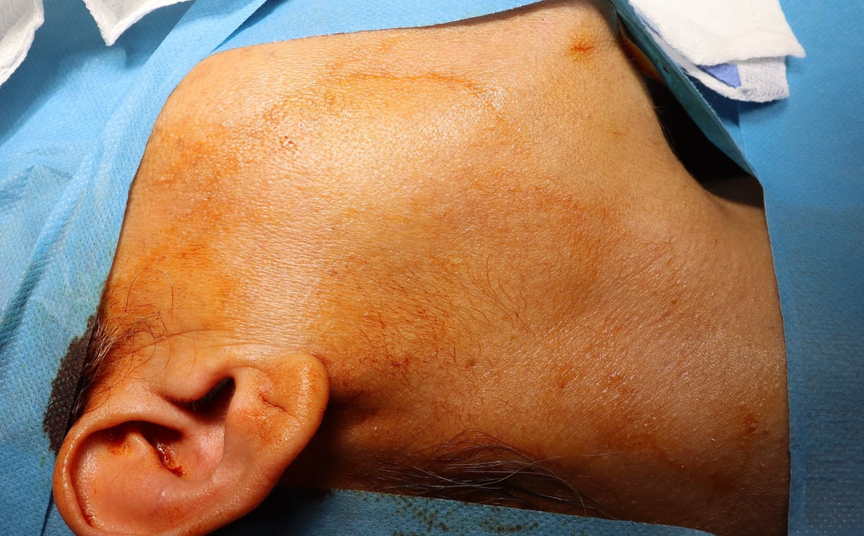 Pleomorphic Adenoma of the Right Parotid Gland in a 51-Year-Old Female ...