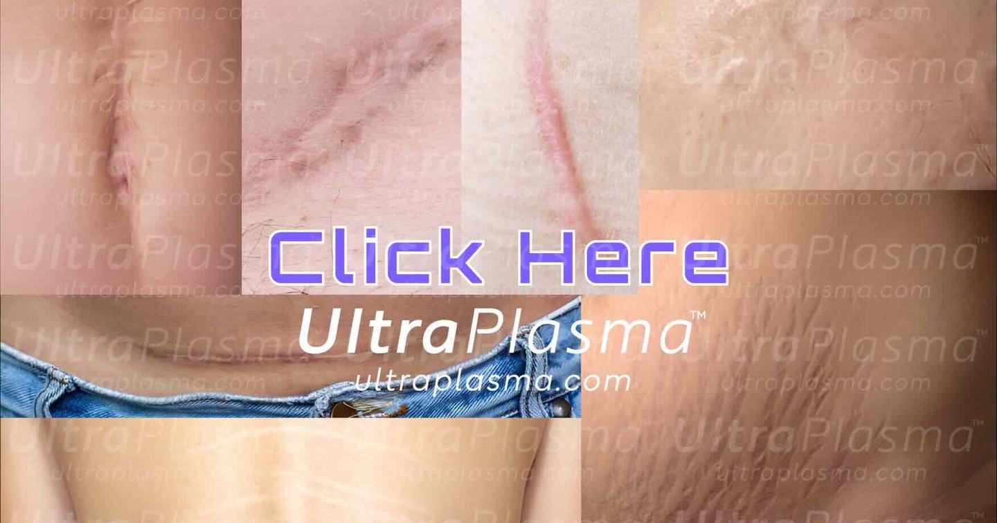 UltraPlasma™ Multiple Scar Treatments | UltraPlasma™ Human ...